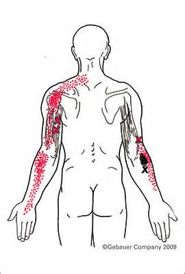 TRICEPS TEAR RECOVERY TIME 2 - Muscle Pull | Muscle Pull