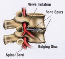 DIFFERENCE BETWEEN A PINCHED NERVE AND MUSCLE STRAIN 2 - Muscle Pull ...