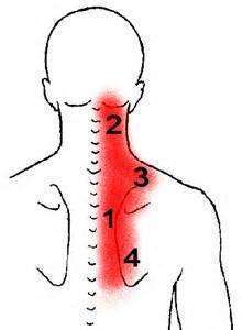 Treating a neck muscle strain - Muscle Pull | Muscle Pull